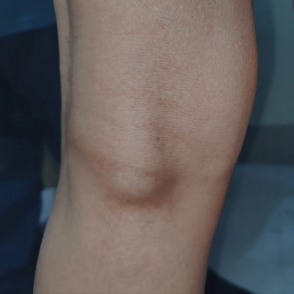 Bakers Cyst